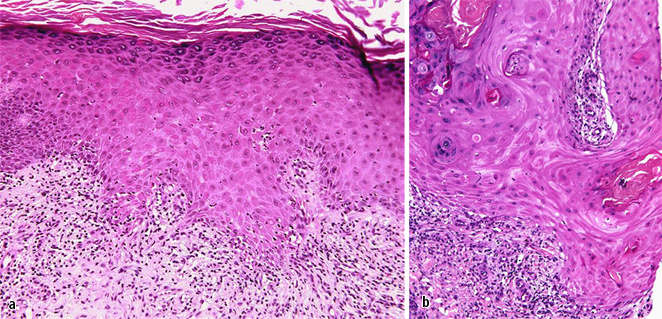 Verruköses spinozelluläres Karzinom auf Lichen ruber hypertrophicus ...