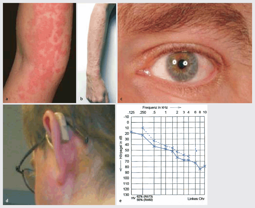 Autoinflammatorische Syndrome/Fiebersyndrome | SpringerLink