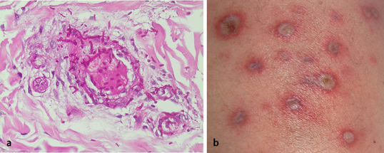 Dermatomykosen durch Fusarien | SpringerLink