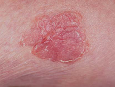 Genodermatosen, die der Praktiker kennen muss | SpringerLink