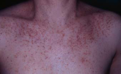 Genodermatosen, die der Praktiker kennen muss | SpringerLink