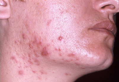 Acne tarda | SpringerLink