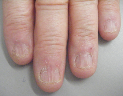 Krankheiten der Nägel | SpringerLink