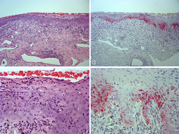 Syphilis | SpringerLink