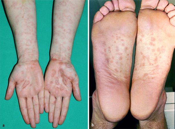 Syphilis | SpringerLink