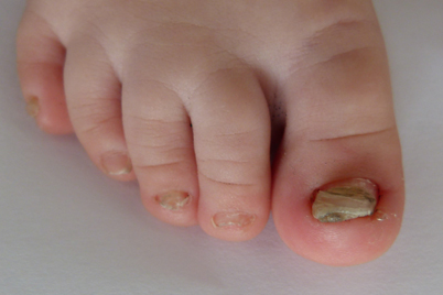 Nagelchirurgie bei Kindern | SpringerLink