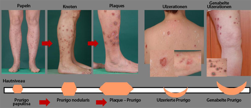 Prurigo | SpringerLink