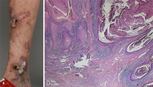 Parallelen zwischen Wundheilung, chronisch entzündlichen Dermatosen und ...
