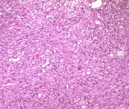 Atypisches Fibroxanthom am Capillitium | SpringerLink