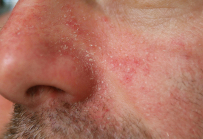 Kutane Malassezia-Infektionen und Malassezia-assoziierte Dermatosen ...