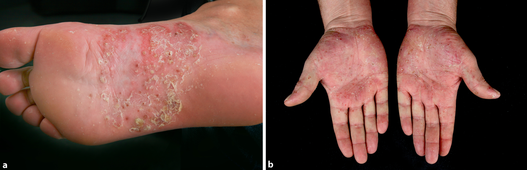 46/m mit Pusteln an Hand- und Fußsohlen | SpringerLink