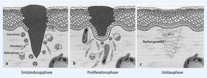 Hyperplastische Narben und Keloide | SpringerLink