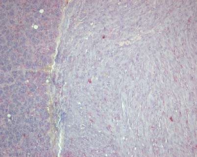 Rezidivierendes und metastasierendes atypisches Fibroxanthom | SpringerLink