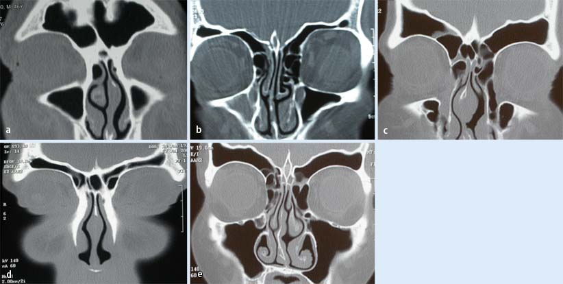 Die endonasale Chirurgie der Stirnhöhle | SpringerLink