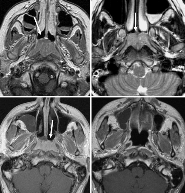 Bildgebung bei Erkrankungen des Nasopharynx | SpringerLink
