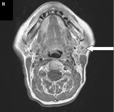 Seltener maligner Tumor der Gl. parotis | SpringerLink