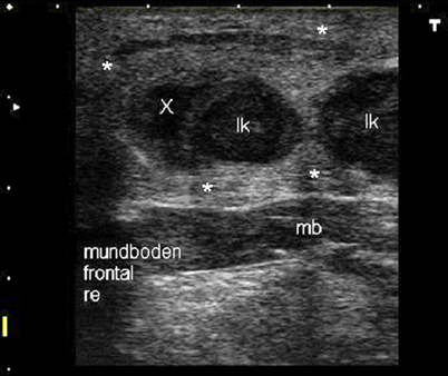 Sonographische Differenzialdiagnose von Raumforderungen der ...