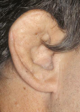 Traumatologie des Ohrs und der lateralen Schädelbasis | SpringerLink