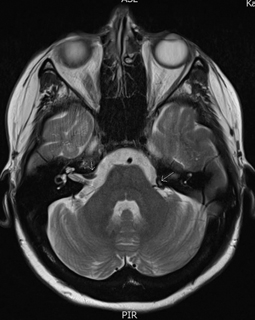 Hyperostose des Meatus acusticus internus | SpringerLink