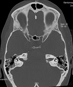 Hyperostose des Meatus acusticus internus | SpringerLink