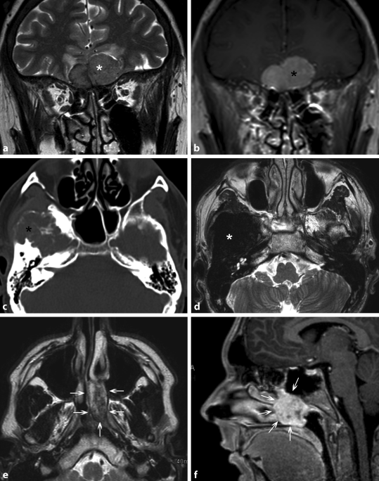 Bildgebung der Nasennebenhöhlen und der Frontobasis | SpringerLink