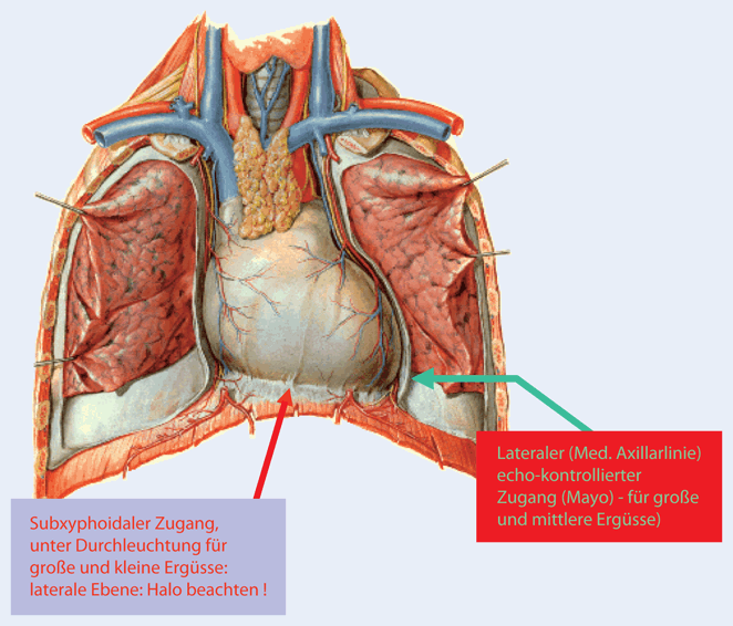 Neue Möglichkeiten der Diagnostik und Therapie der Perikarditis ...