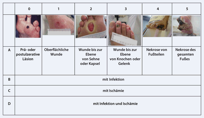 Das diabetische Fußsyndrom | SpringerLink