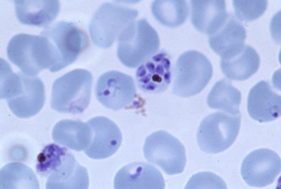 Malaria | SpringerLink