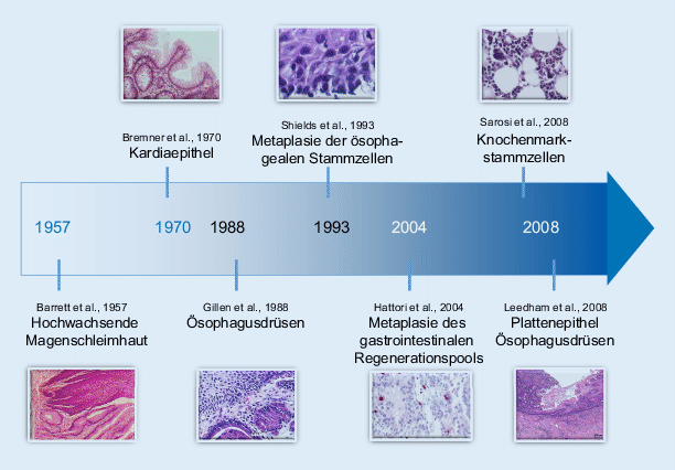 Barrett-Ösophagus | SpringerLink