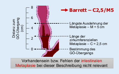 Barrett-Ösophagus | SpringerLink