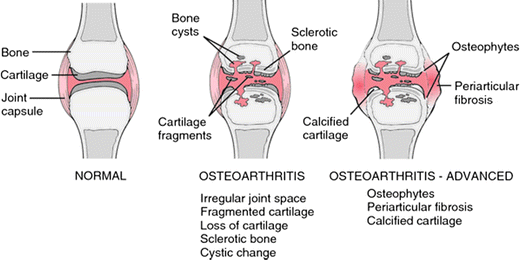 An osteoarthritis triple play | SpringerLink