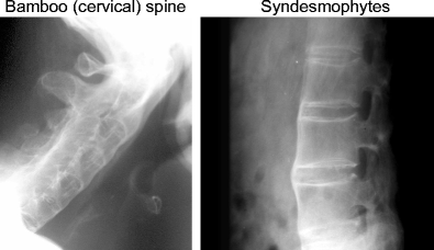 Mesenchymal stem cells provide novel insights into ankylosing ...
