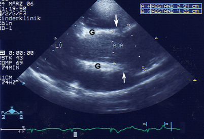 Ektasie und Knickbildungen der Aorta, Hypertelorismus und Uvula bifida ...