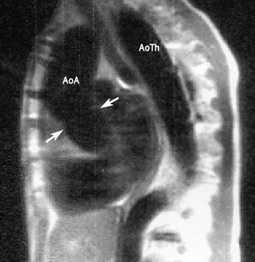 Ektasie und Knickbildungen der Aorta, Hypertelorismus und Uvula bifida ...
