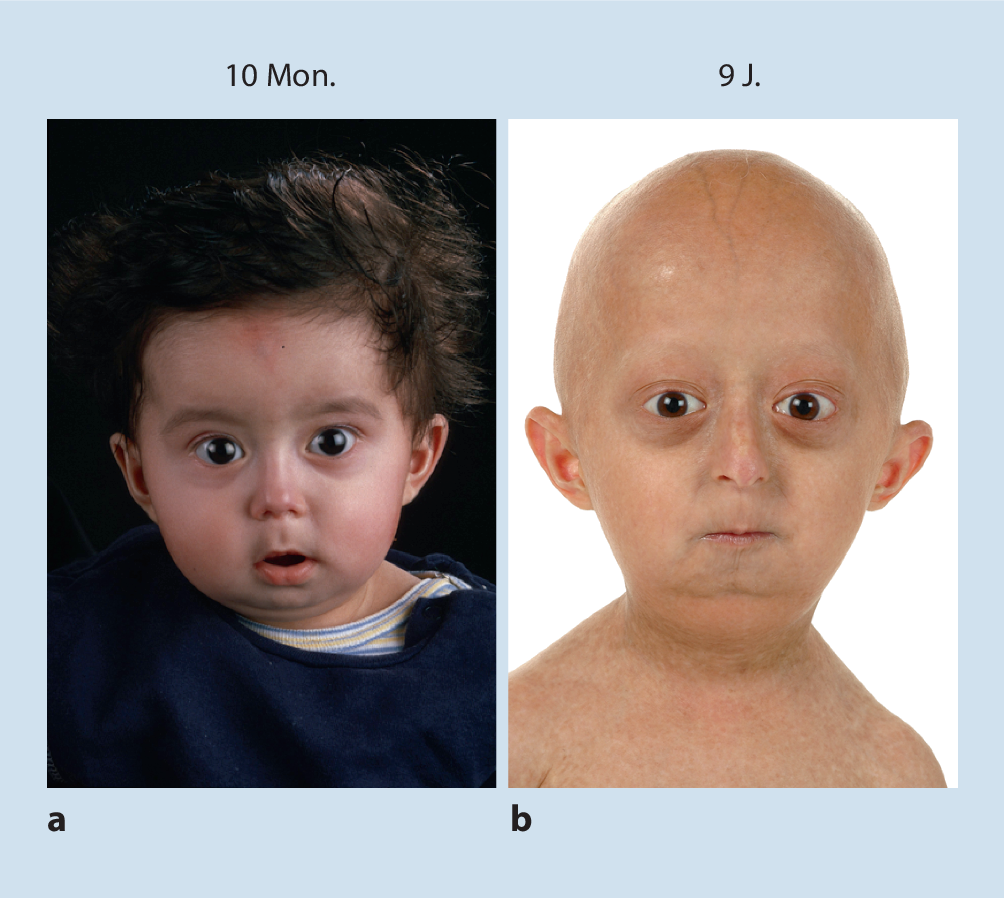 Blickdiagnose angeborener Stoffwechselerkrankungen | SpringerLink