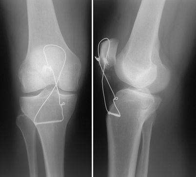 Augmentation von Patellafrakturen und Patellarsehnenrupturen mittels ...