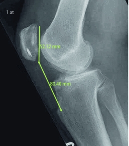Augmentation von Patellafrakturen und Patellarsehnenrupturen mittels ...