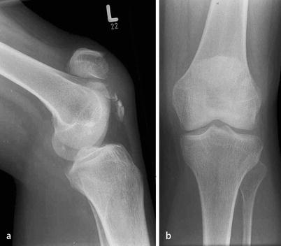 Augmentation von Patellafrakturen und Patellarsehnenrupturen mittels ...