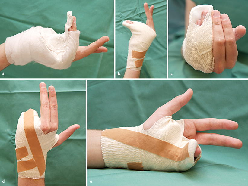 Frakturen des Handgelenks und der Hand | SpringerLink Frakturen des Handgelenks und der Hand | SpringerLink
