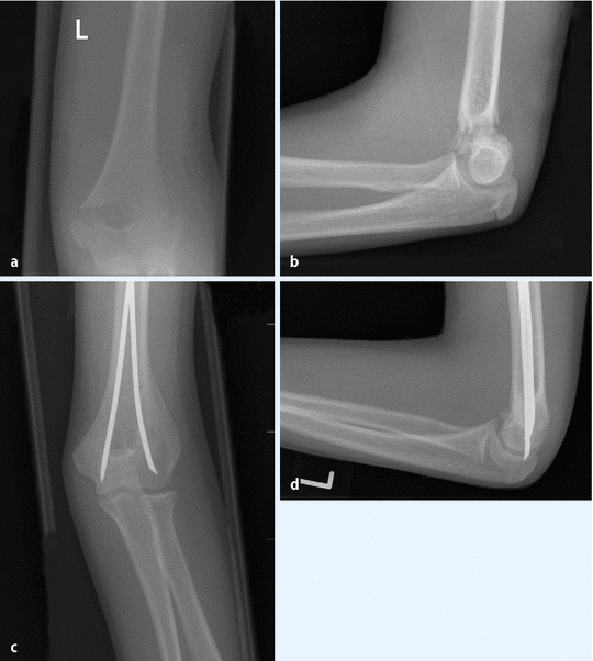 Die elastisch-stabile intramedulläre Nagelung (ESIN) der suprakondylären Humerusfraktur im ...