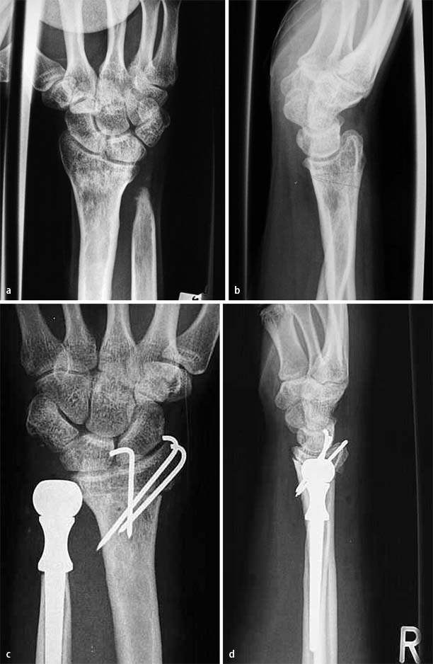 Ulnakopfprothese | SpringerLink