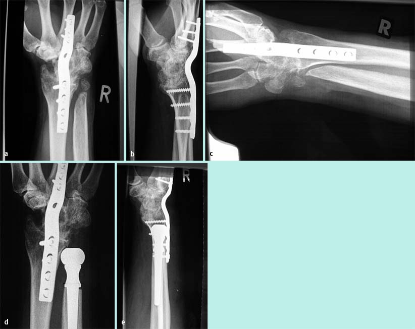 Ulnakopfprothese | SpringerLink