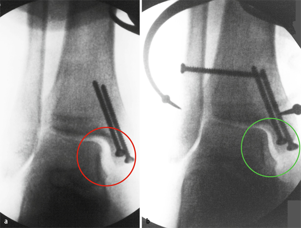 Sprunggelenkfrakturen | SpringerLink