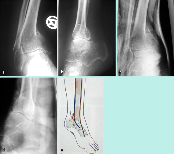 Distale Tibiafraktur | SpringerLink