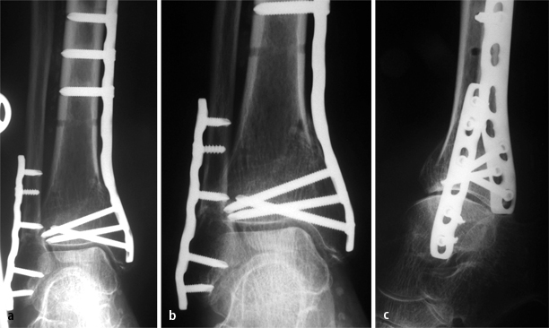 Distale Tibiafraktur | SpringerLink