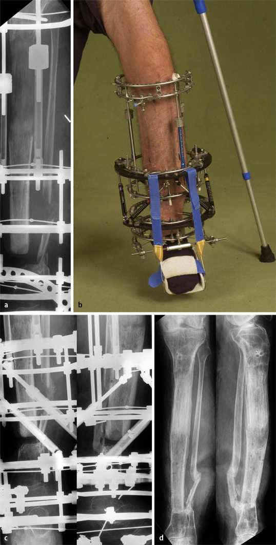 Der Taylor Spatial Frame | SpringerLink