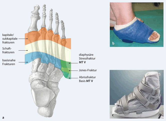 Metatarsale Frakturen | SpringerLink