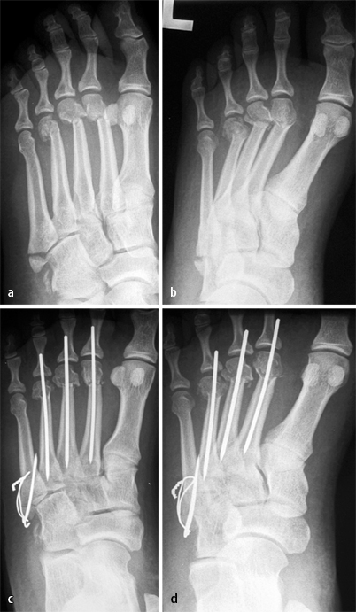 Metatarsale Frakturen | SpringerLink