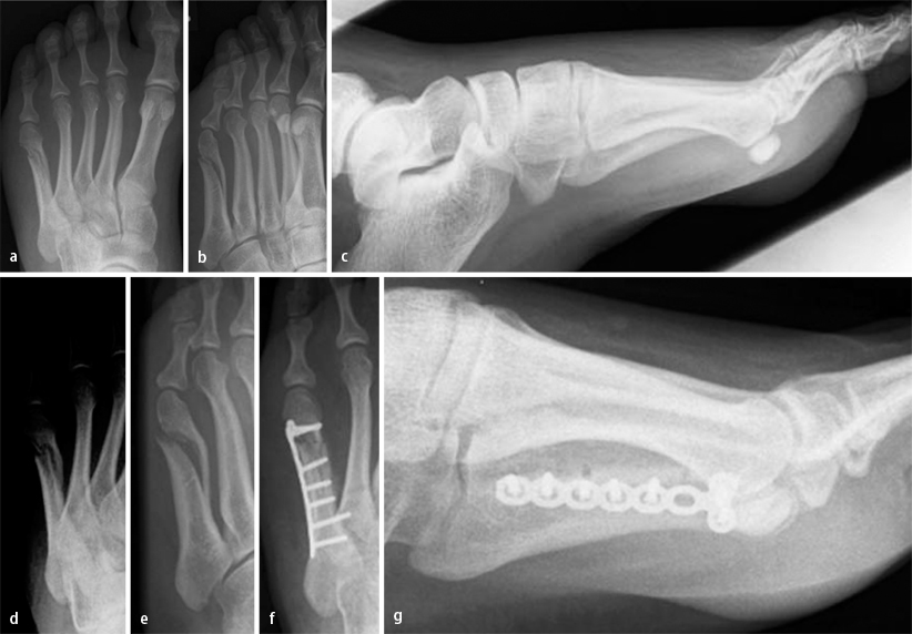 Metatarsale Frakturen | SpringerLink