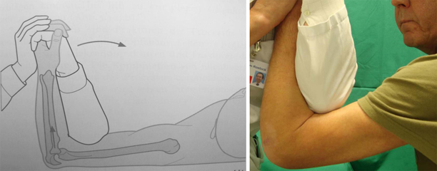 Luxation des Ellenbogengelenks des Erwachsenen | SpringerLink